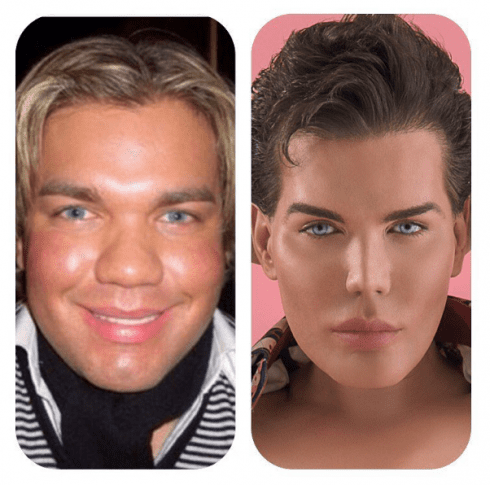 Marbella surgery addict insures his ‘Barbie’s Ken’ body for €1.1 ...