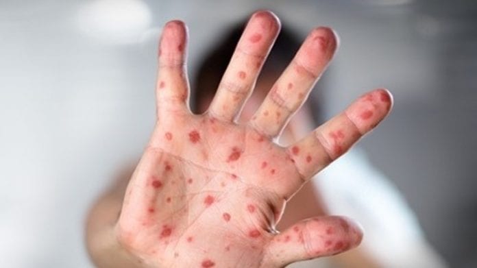 Measles outbreak in Murcia with 400 people traced following baptism ...