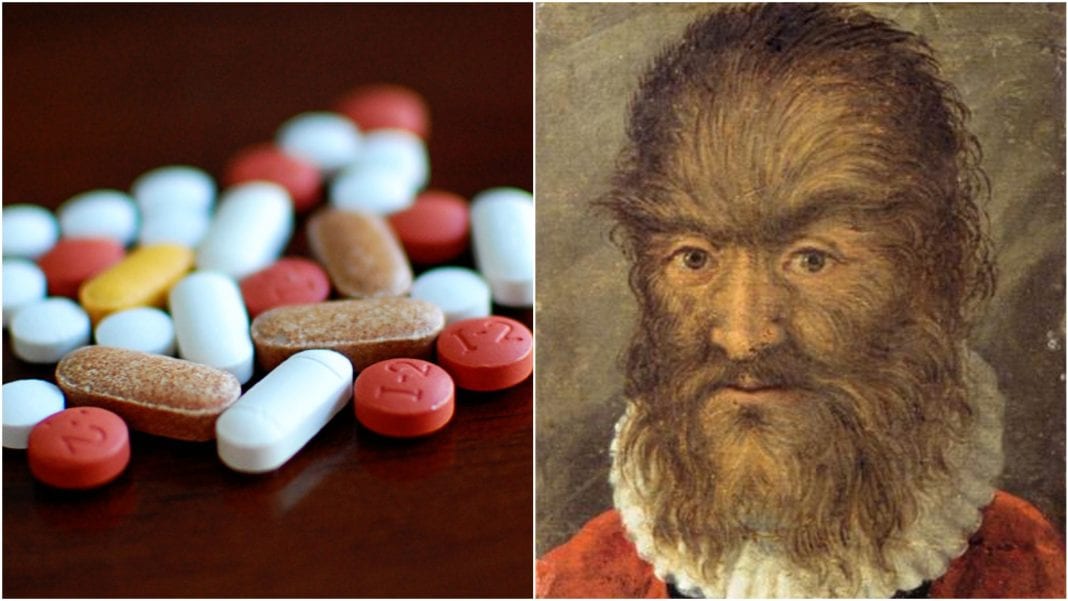 WARNING: 13 children develop 'werewolf syndrome' after taking ...