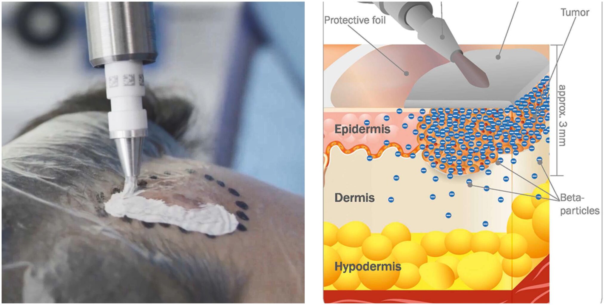 Groundbreaking skin cancer treatment lands in Spain boasting ‘scar-free ...